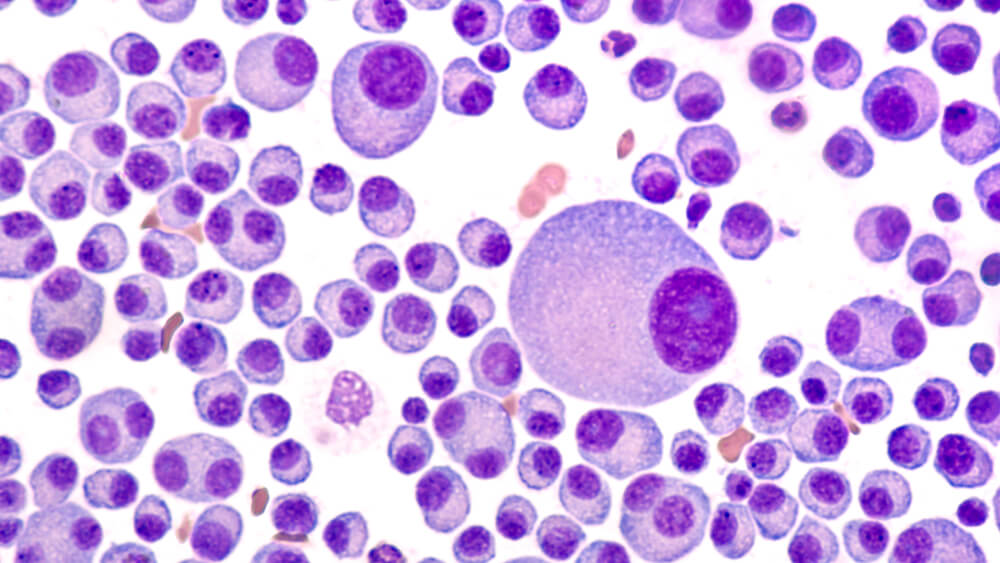 Mit "Hemibodies" gegen das Multiple Myelom