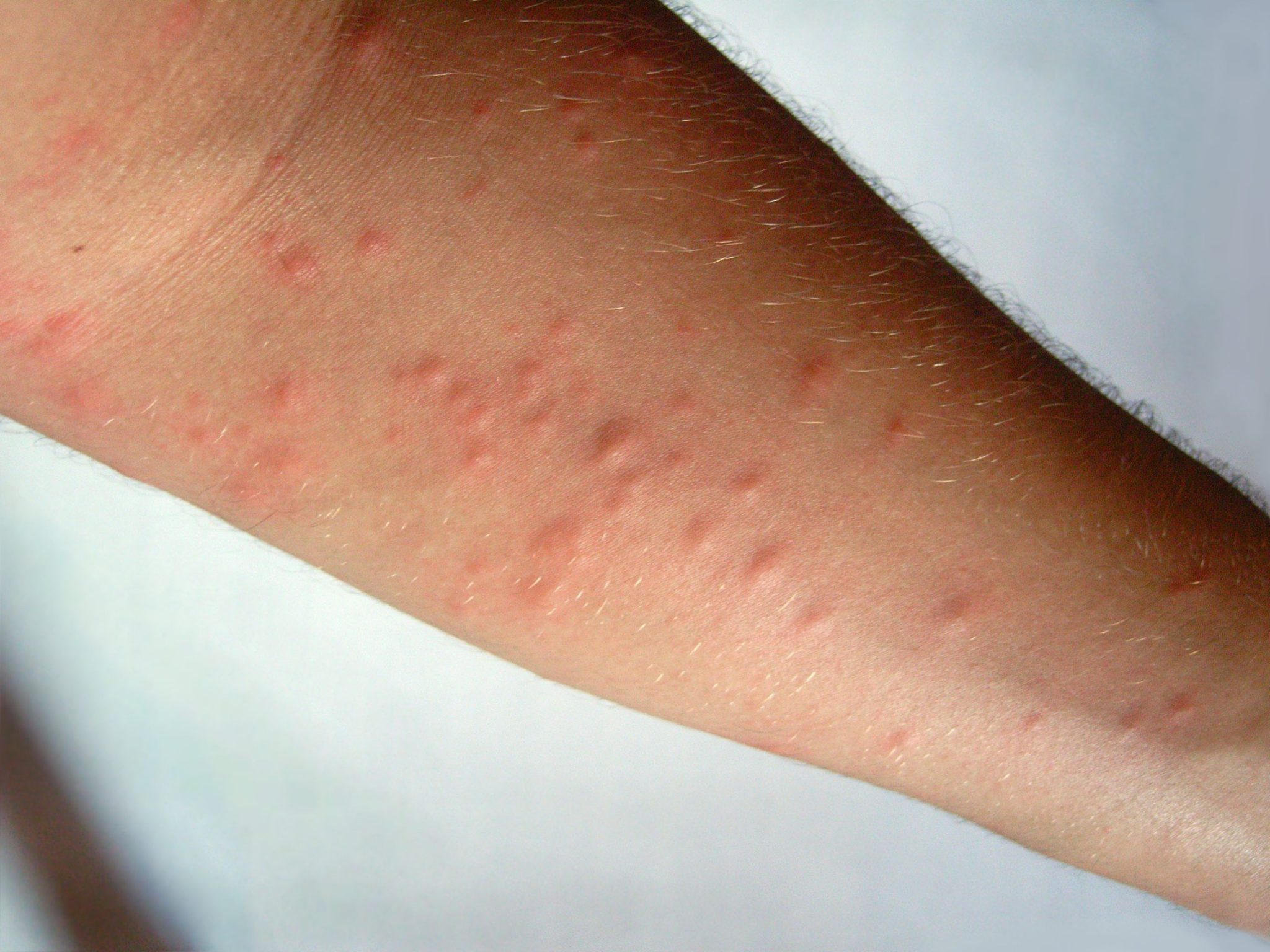 Eichenprozessionsspinner: Gefahr durch Brennhaare - DocFinder