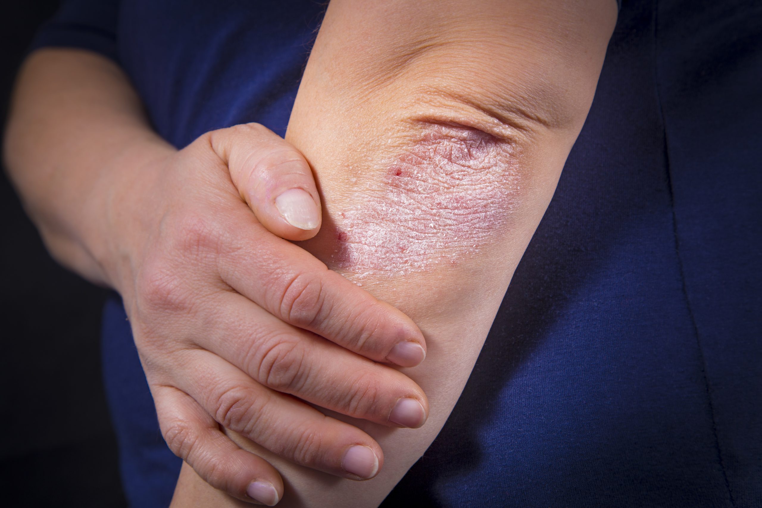 Psoriasis (Schuppenflechte) - Definition, Ursache, Behandlung ...